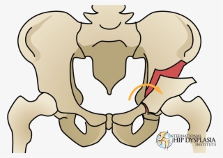 Pao2 - Periacetabular Osteotomy Transparent PNG - 1313x869 - Free ...